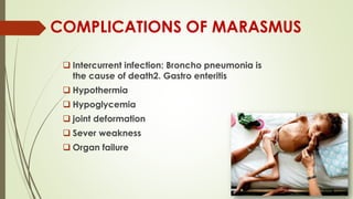 MARASMUS.pdf marsmus pptx difference between marsmus and kwashiorkor presentation about marsmus ...