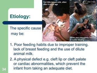 Marasmus. acute protein malnutrition.ppt