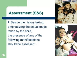 Marasmus. acute protein malnutrition.ppt