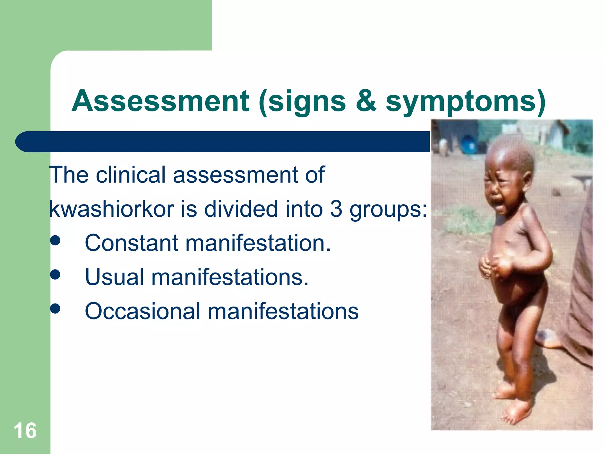 Marasmus kwashiorkor | PPT