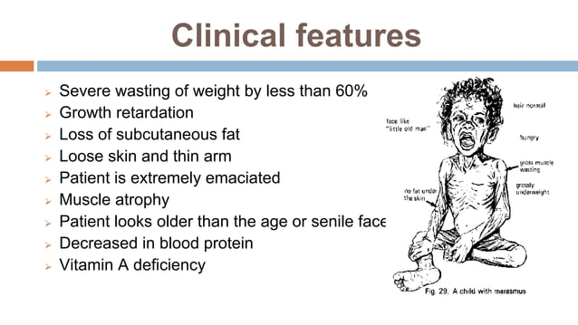Marasmus final draft.pptx | Digestive Disorders | Diseases and Conditions