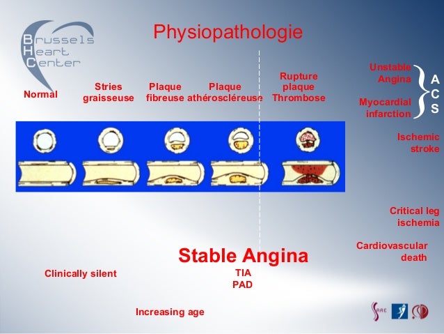 Dr Marc Castadot: Angor stable – Définition et actualités thérapeutiq…