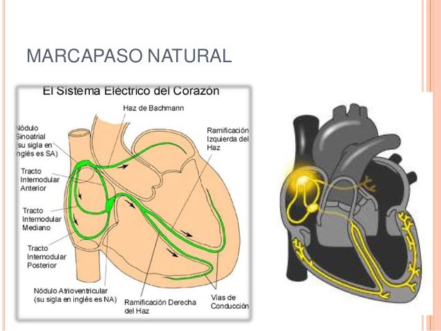Marcapaso cardiaco