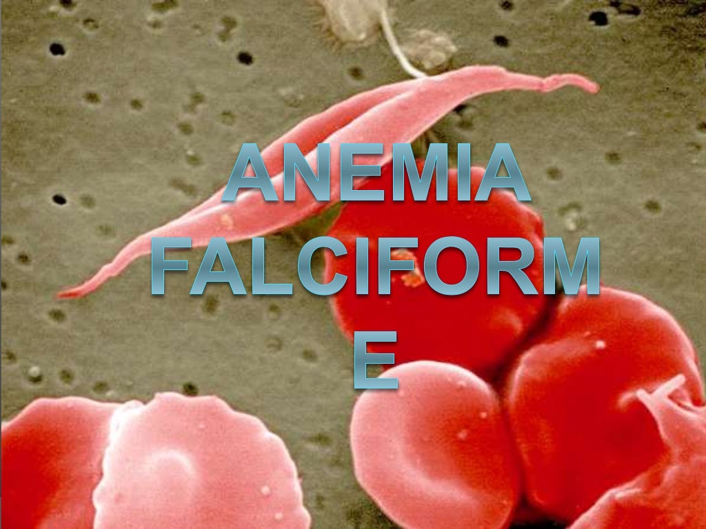 Anemia Falciforme