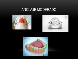 Biomecánica en ortodoncia. Especialidad. | PPTX