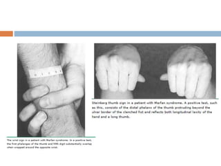 Marfan Syndrome Hand Test