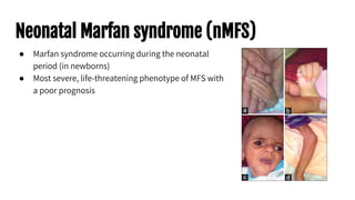 Case Study: Marfan Syndrome | PDF