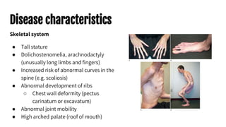 Case Study: Marfan Syndrome | PDF