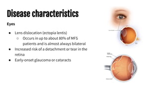 Case Study: Marfan Syndrome | PDF