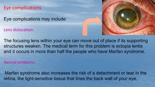 Marfan syndrome - a detailed study ( all medical information ) | PPTX