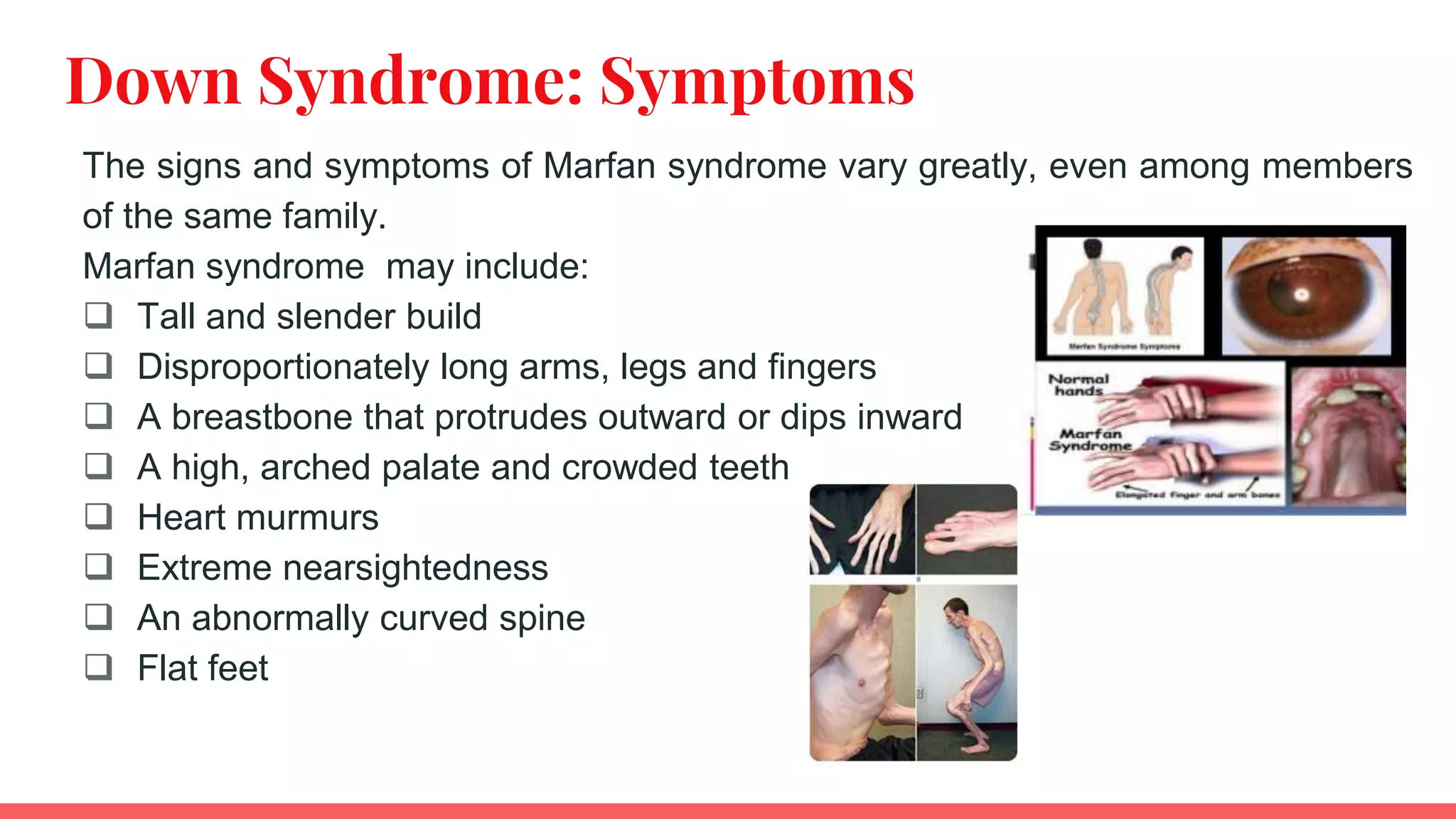Marfan syndrome | PPTX