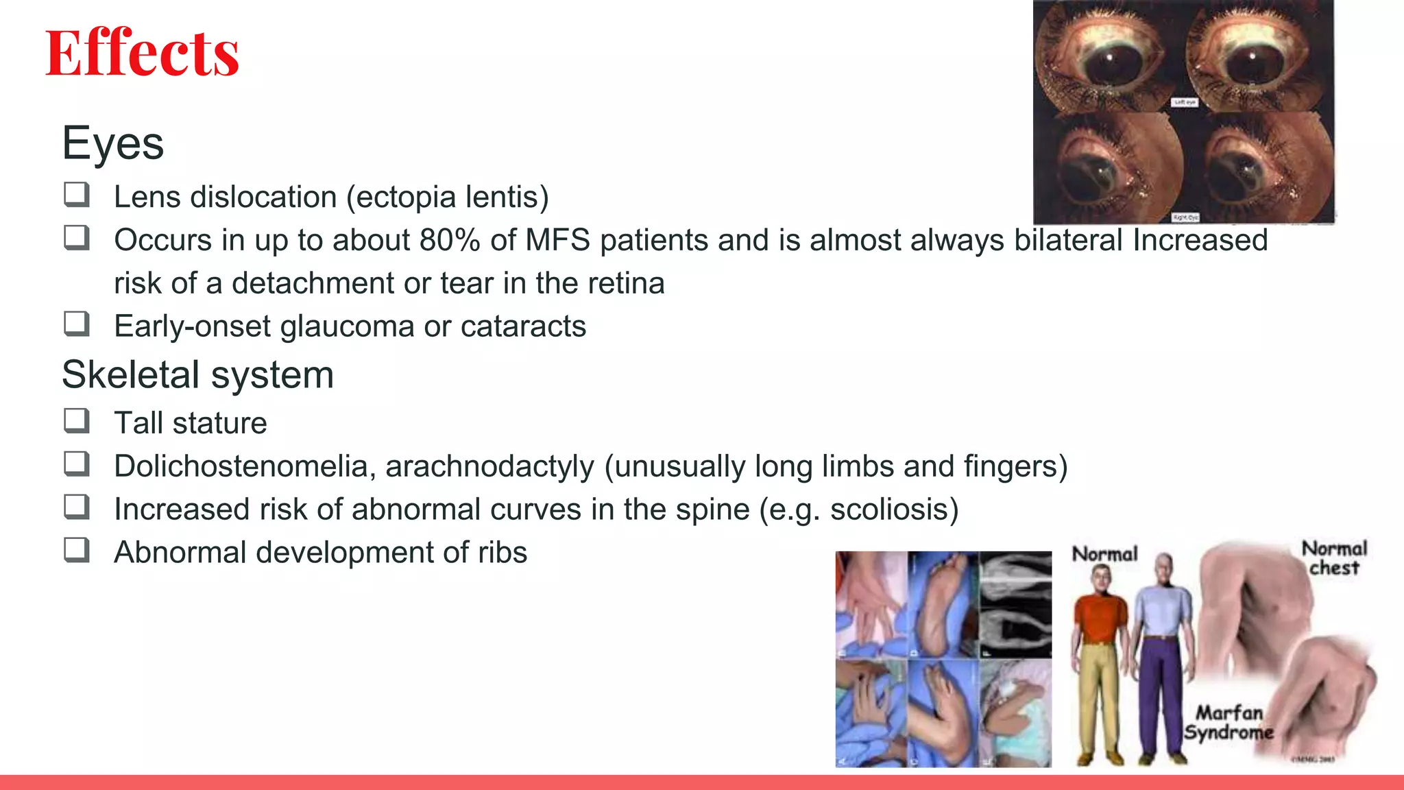 Marfan syndrome | PPTX