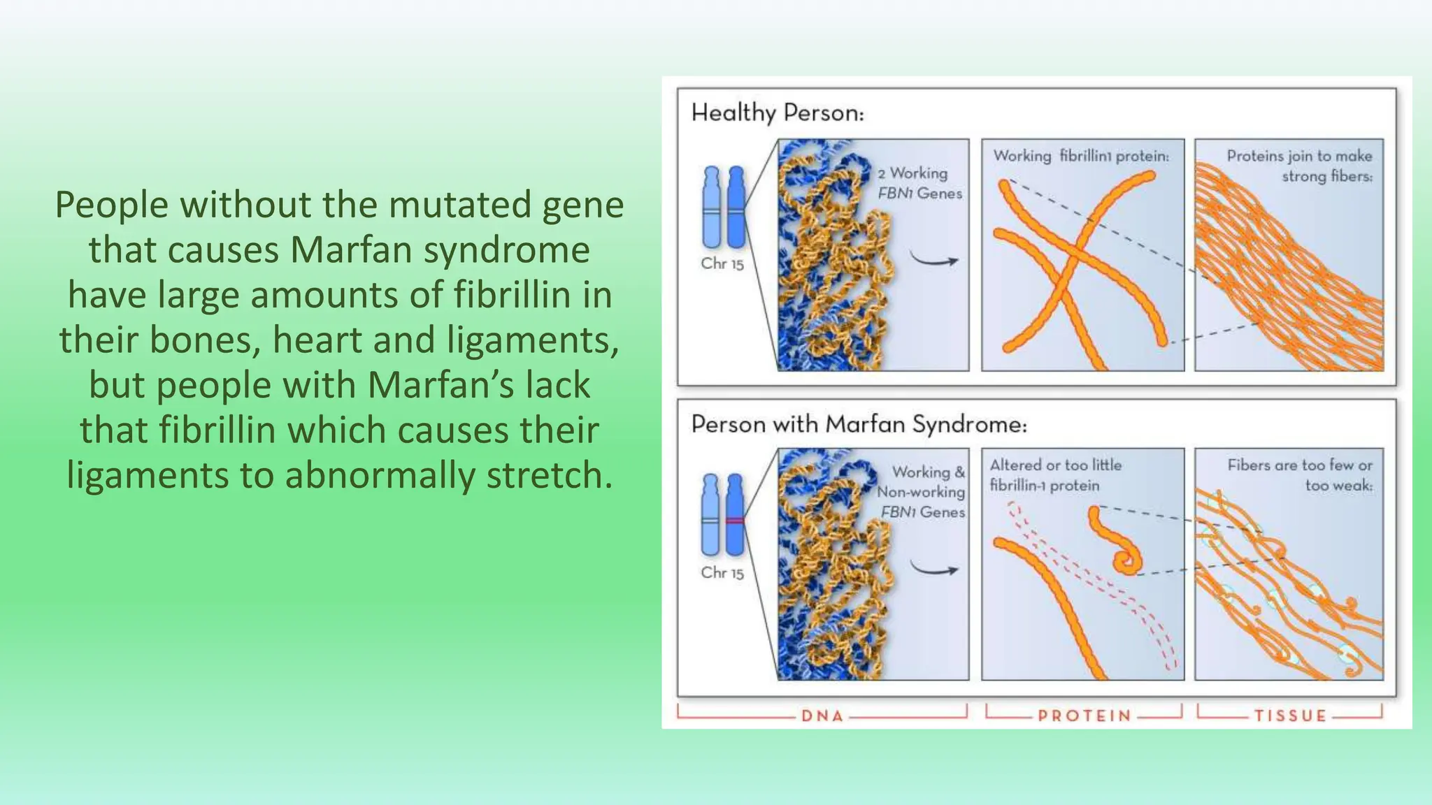 Marfan Syndrome.pptx