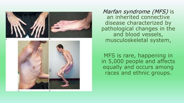 Marfan Syndrome.pptx