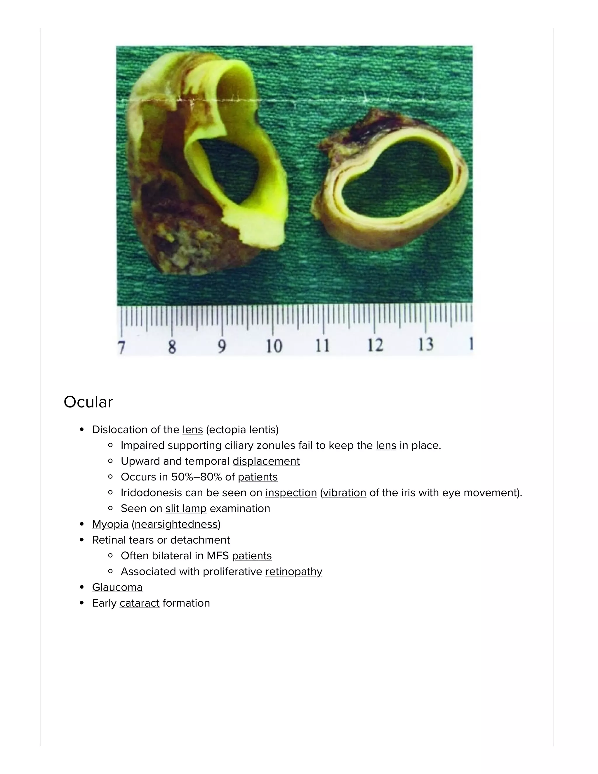 Marfan Syndrome pdf | PDF