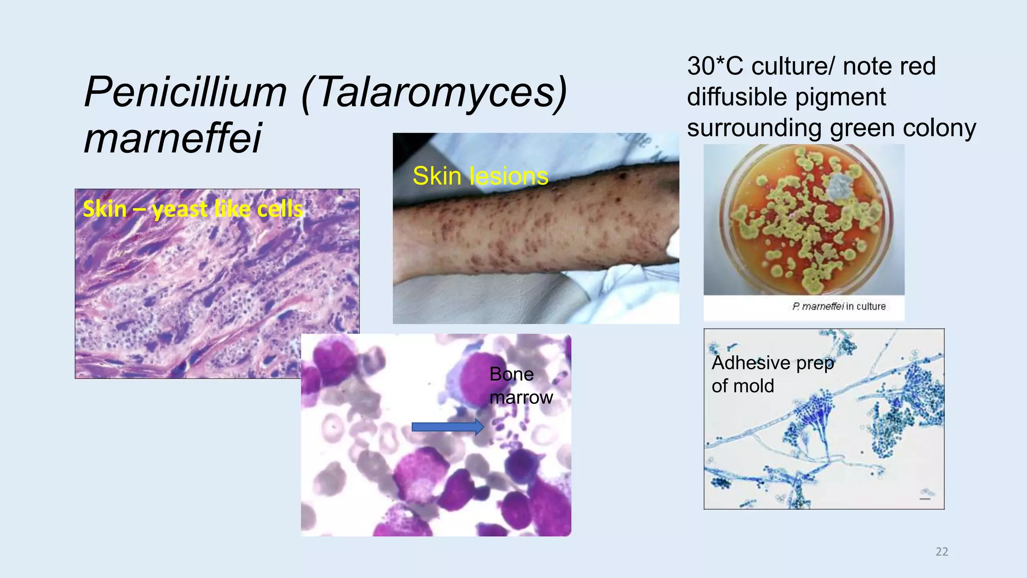 Fungal Pathology in Tissue | PPTX