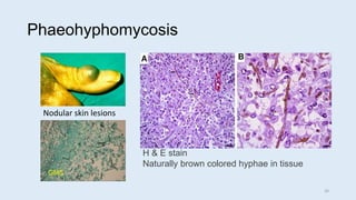 Fungal Pathology in Tissue | PPTX