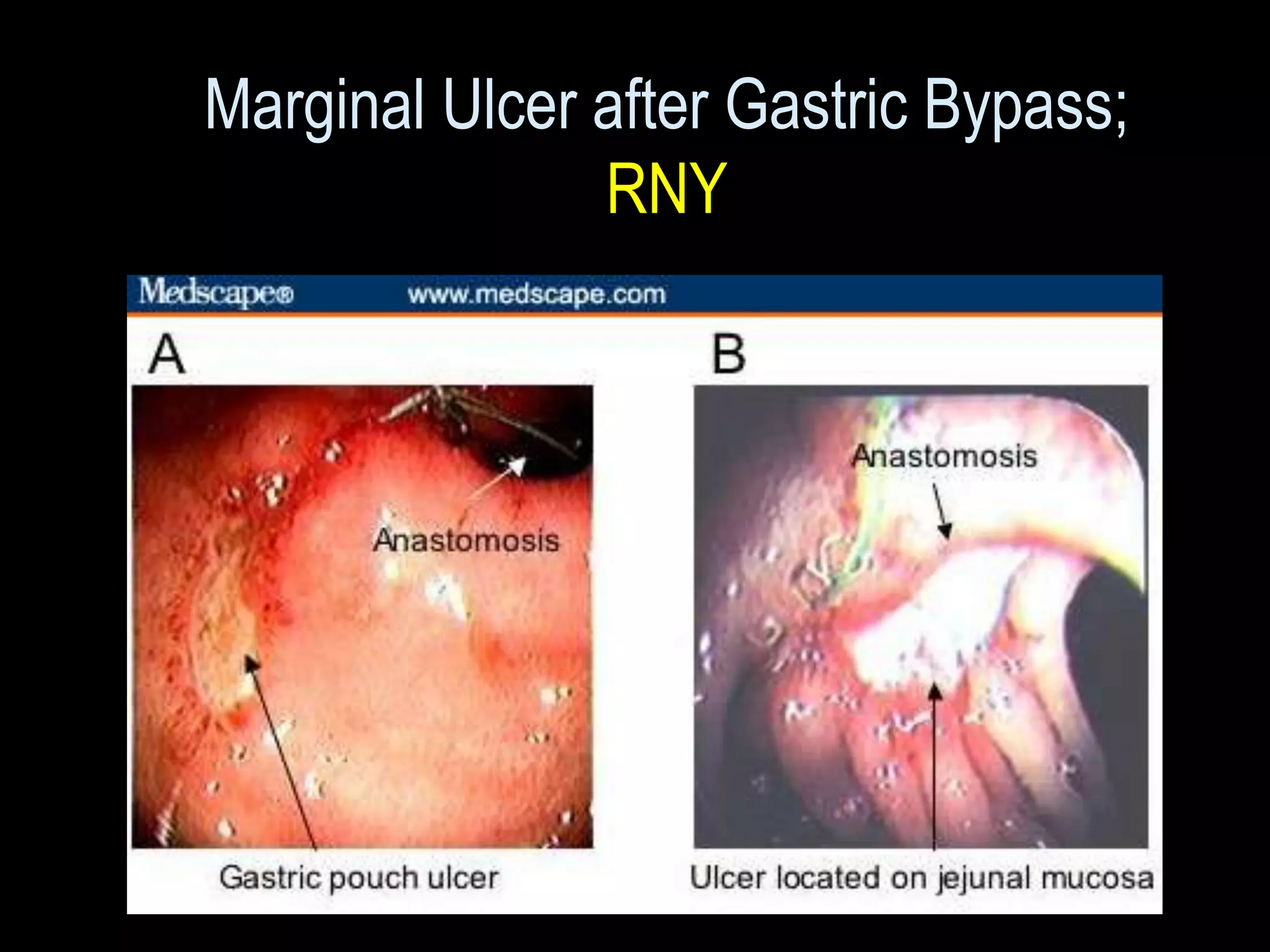 Marginal ulcer gastric bypass (MGB vs RNY) | PPTX