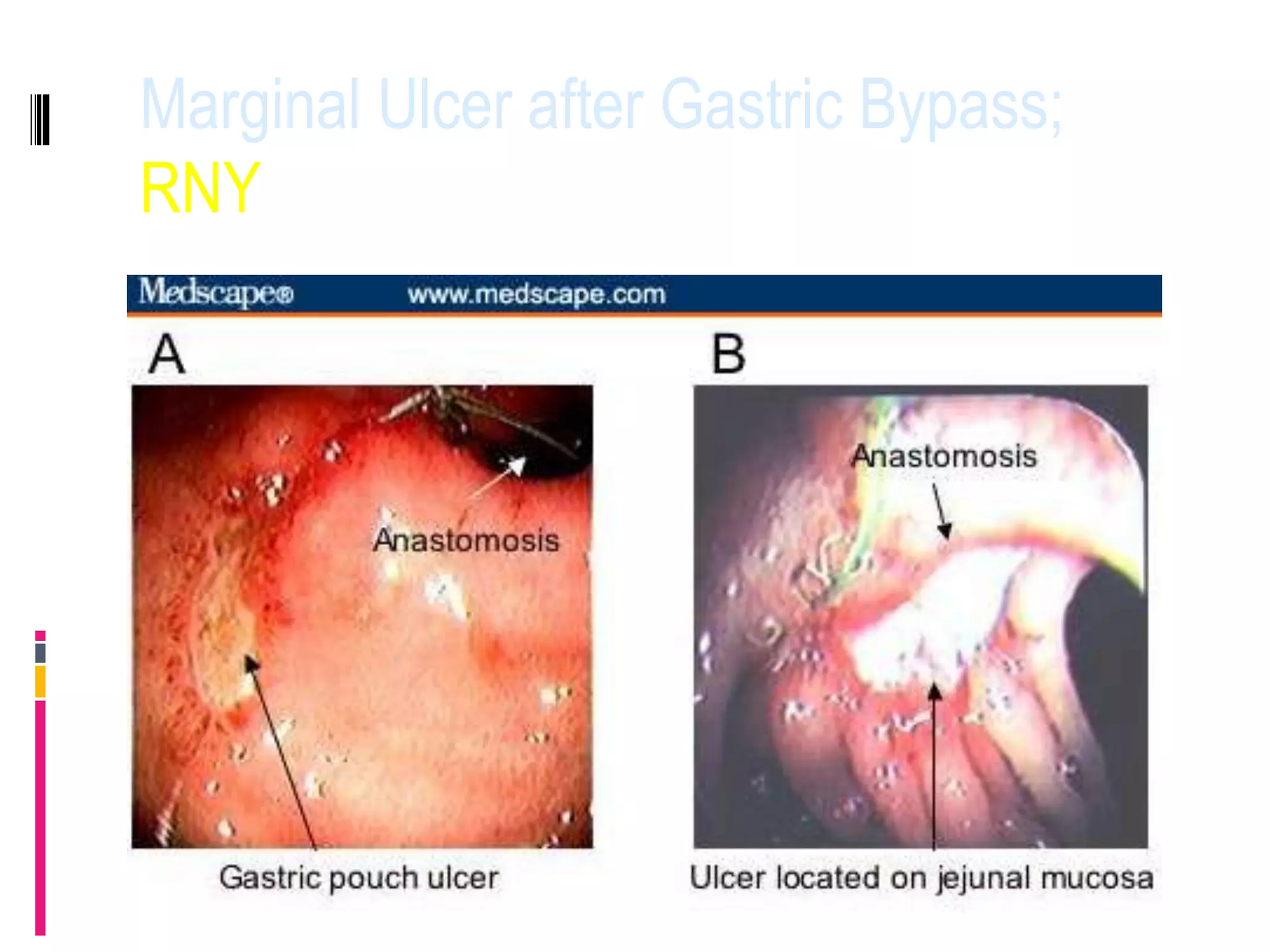 Marginal ulcer gastric bypass | PPTX