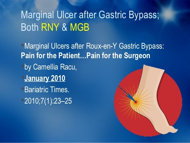 Marginalulcergastricbypass4 blue