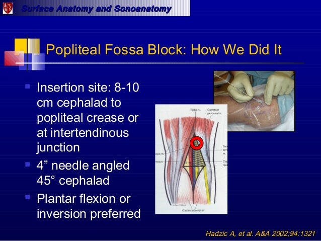 Surface anatomy and sonoanatomy for the occasional regional anesthesi…