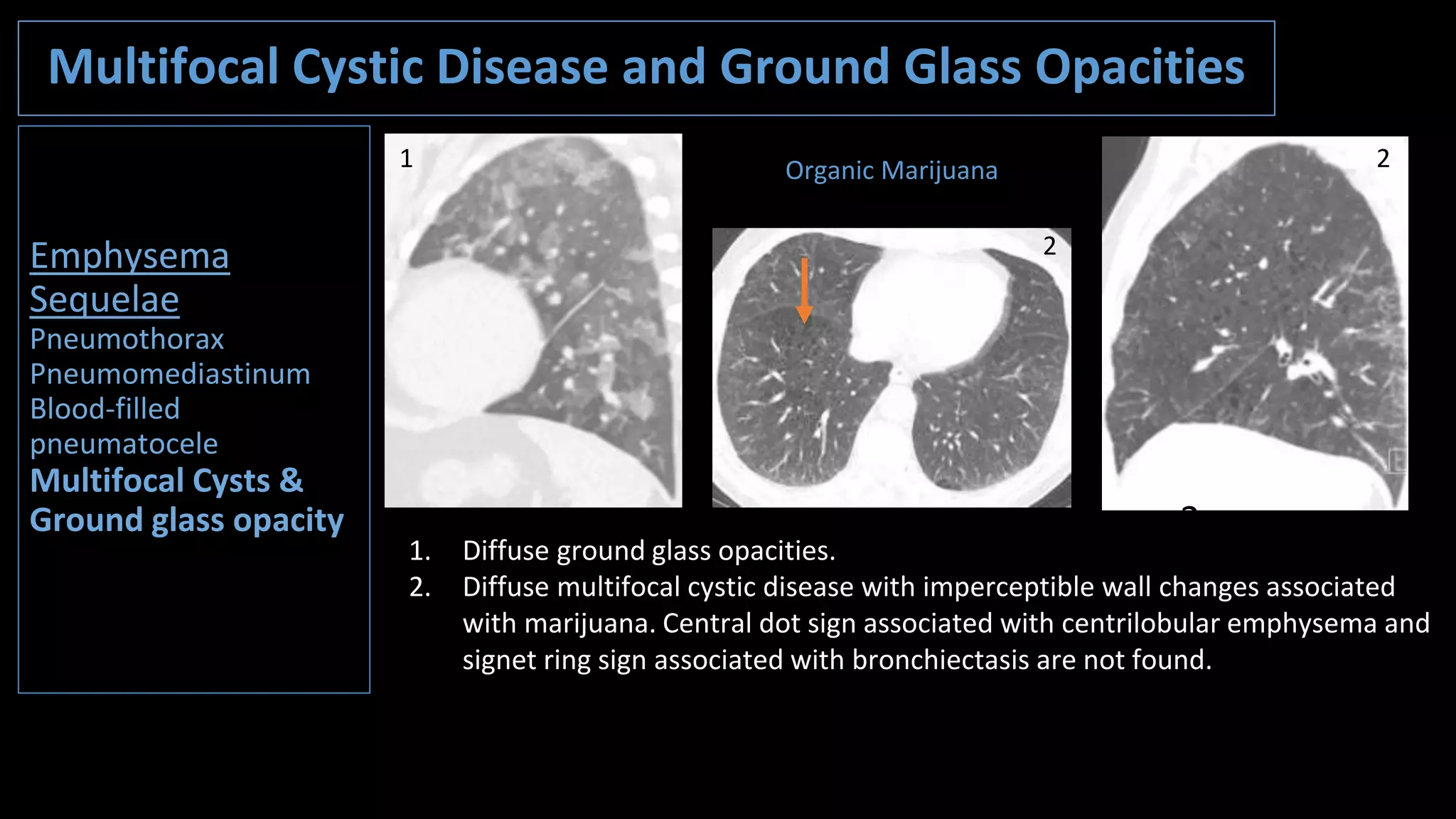 Marijuana rsna presentation (final) | PPTX