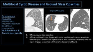 Marijuana rsna presentation (final) | PPTX