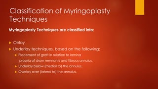 Maringoplasty | PPTX