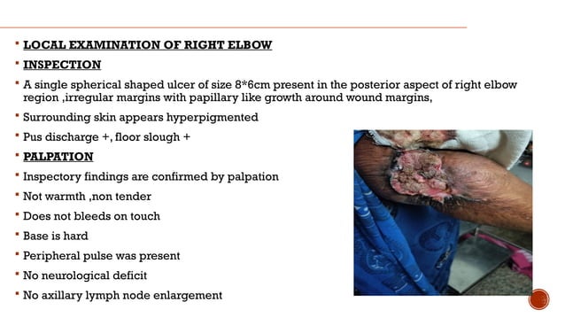 Marjolins ulcer case report presentation | PPTX
