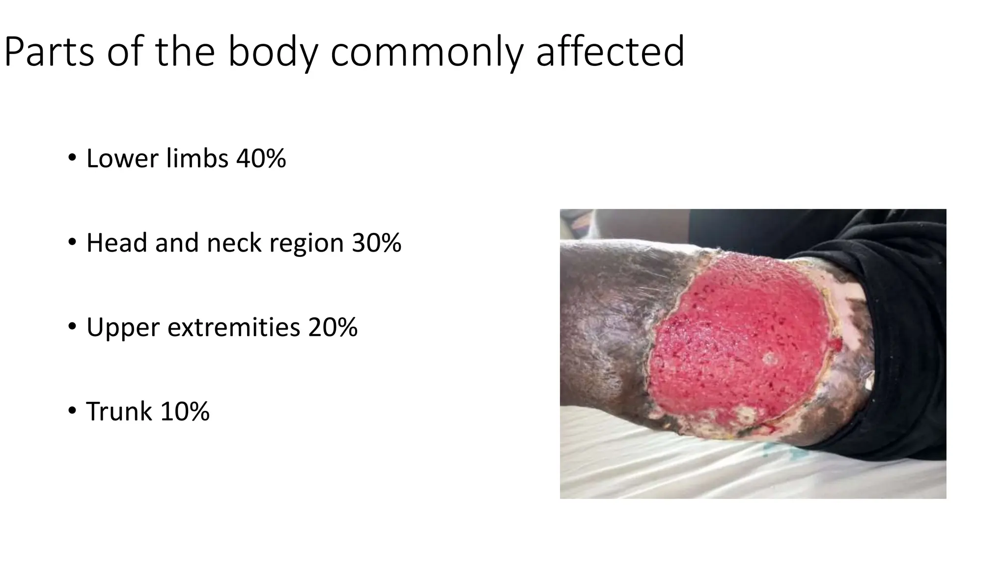 A Power Point Presentation on Marjolin's ulcer.pptx