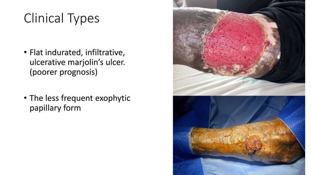 A Power Point Presentation on Marjolin's ulcer.pptx