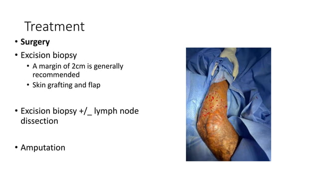 A Power Point Presentation on Marjolin's ulcer.pptx