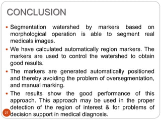 Marker Controlled Segmentation Technique for Medical application | PPT