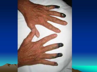 Mark inglis – the unstoppable man | PPT