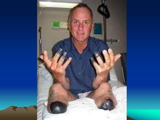 Mark inglis – the unstoppable man | PPT