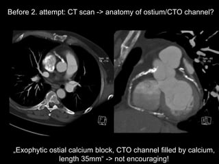 Markus Meyer Gessner - Break through the wall- RCA ostial CTO | PPT