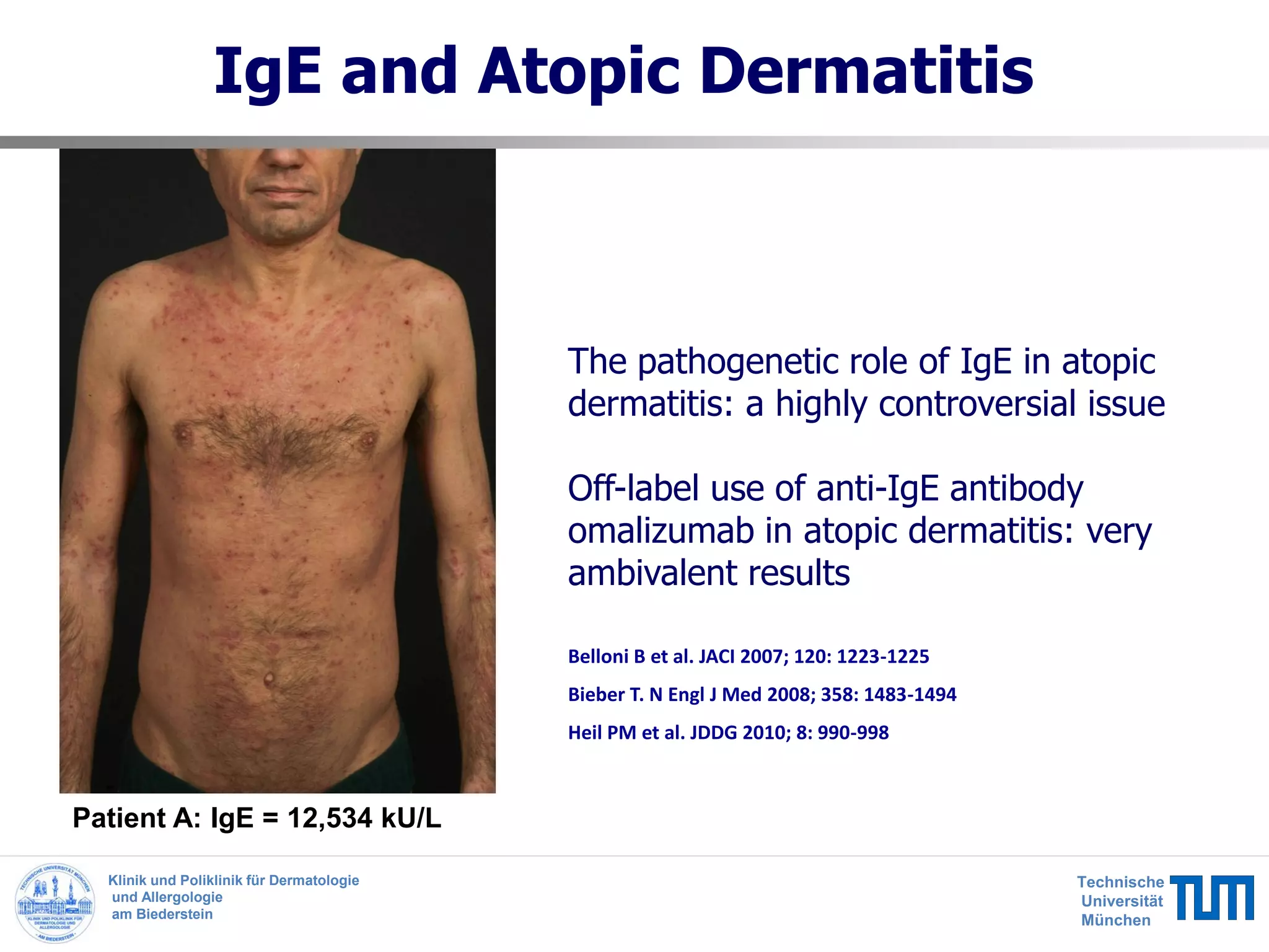 Targeting Grossly Elevated IgE. Prof. Dr. Markus Ollert