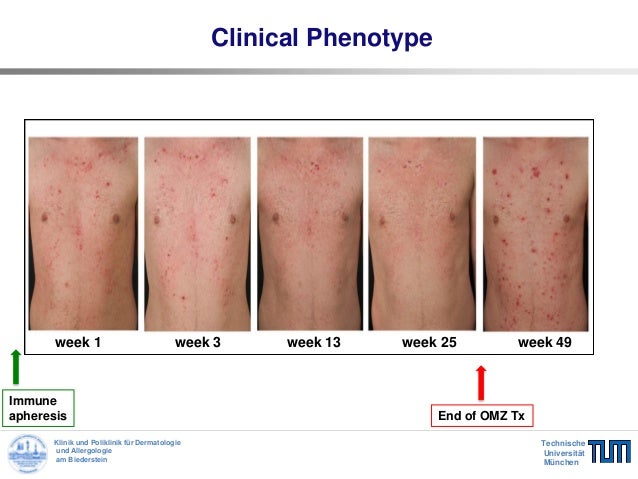 Targeting grossly elevated IgE: a novel therapeutic option in severe