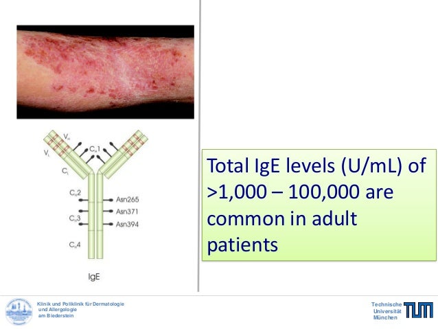 Targeting grossly elevated IgE: a novel therapeutic option in severe