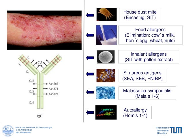 Targeting grossly elevated IgE: a novel therapeutic option in severe