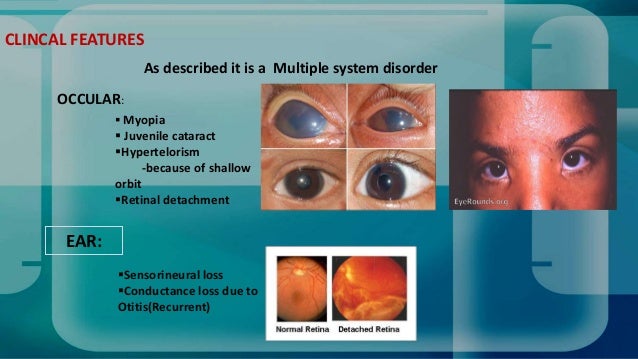 Marshall syndrome