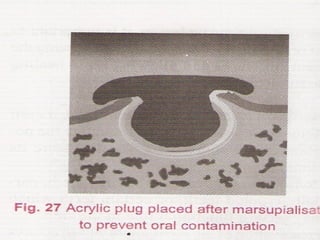 MARSUPIALIZATION___ENUCLEATION_IN_TREATMENT_OF_CYSTS_OF_ORAL_CAVITY ...