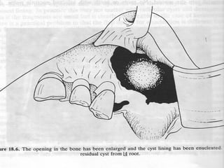 MARSUPIALIZATION___ENUCLEATION_IN_TREATMENT_OF_CYSTS_OF_ORAL_CAVITY ...