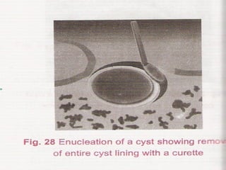 MARSUPIALIZATION___ENUCLEATION_IN_TREATMENT_OF_CYSTS_OF_ORAL_CAVITY ...