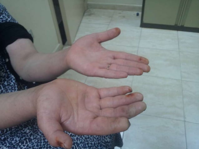 Syringomyelia ( Morvan syndrome) Electrodiagnosis | PPTX