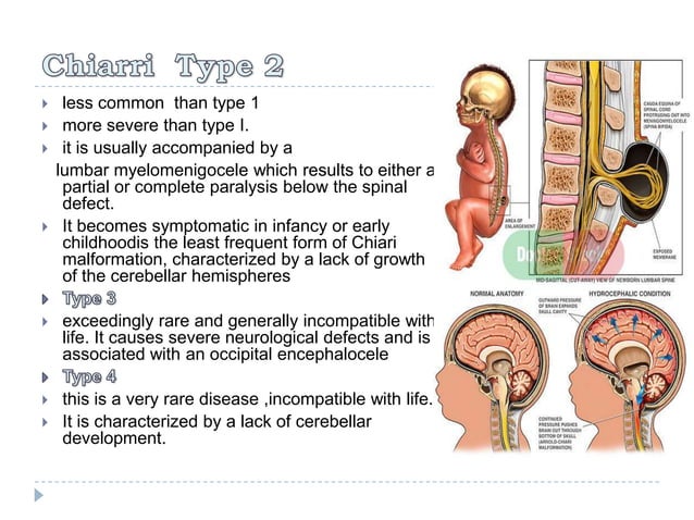 Syringomyelia ( Morvan syndrome) Electrodiagnosis | PPTX