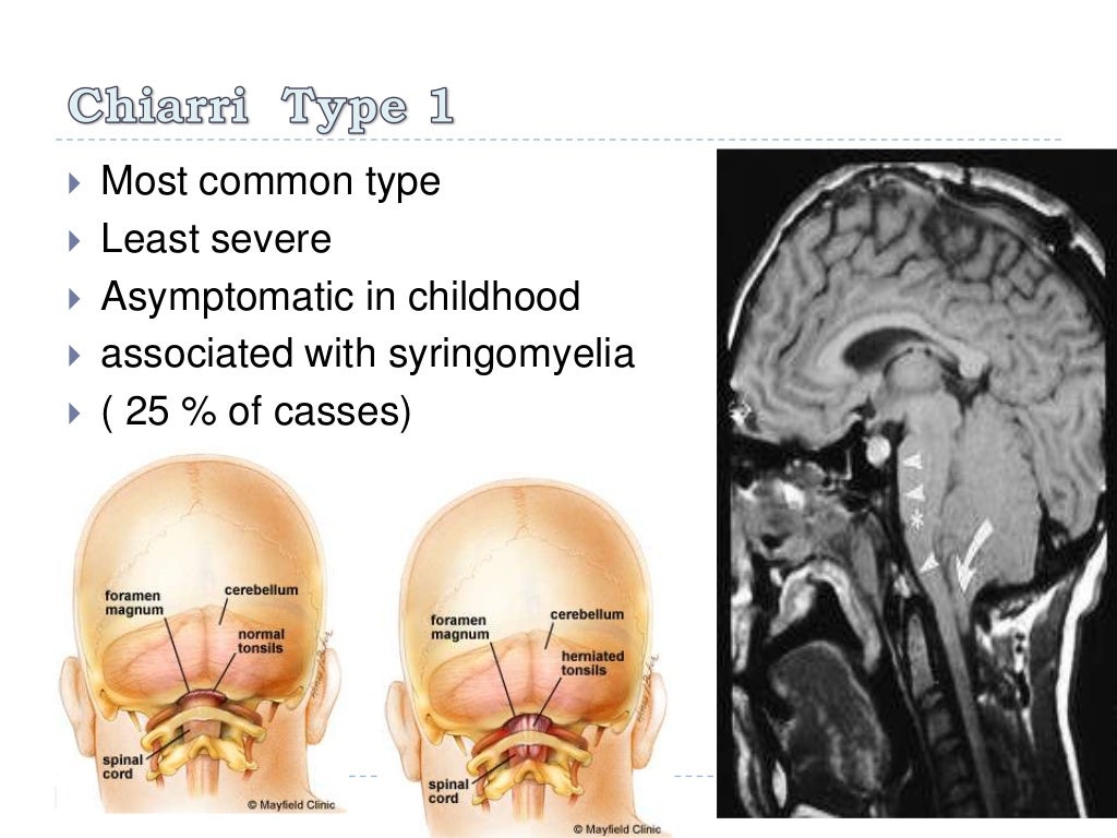 Syringomyelia ( Morvan syndrome) Electrodiagnosis