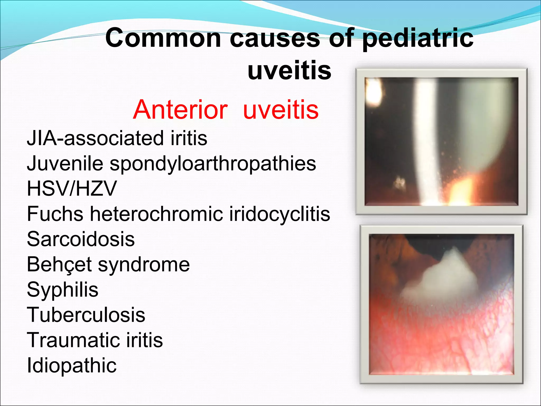 Uveitis in children - by dr. Marwa Mostafa (MS) | PPT
