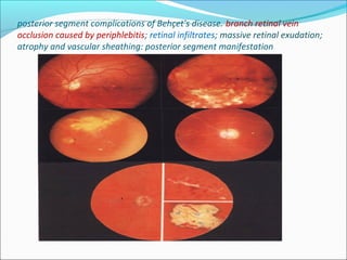 Uveitis in children - by dr. Marwa Mostafa (MS) | PPT
