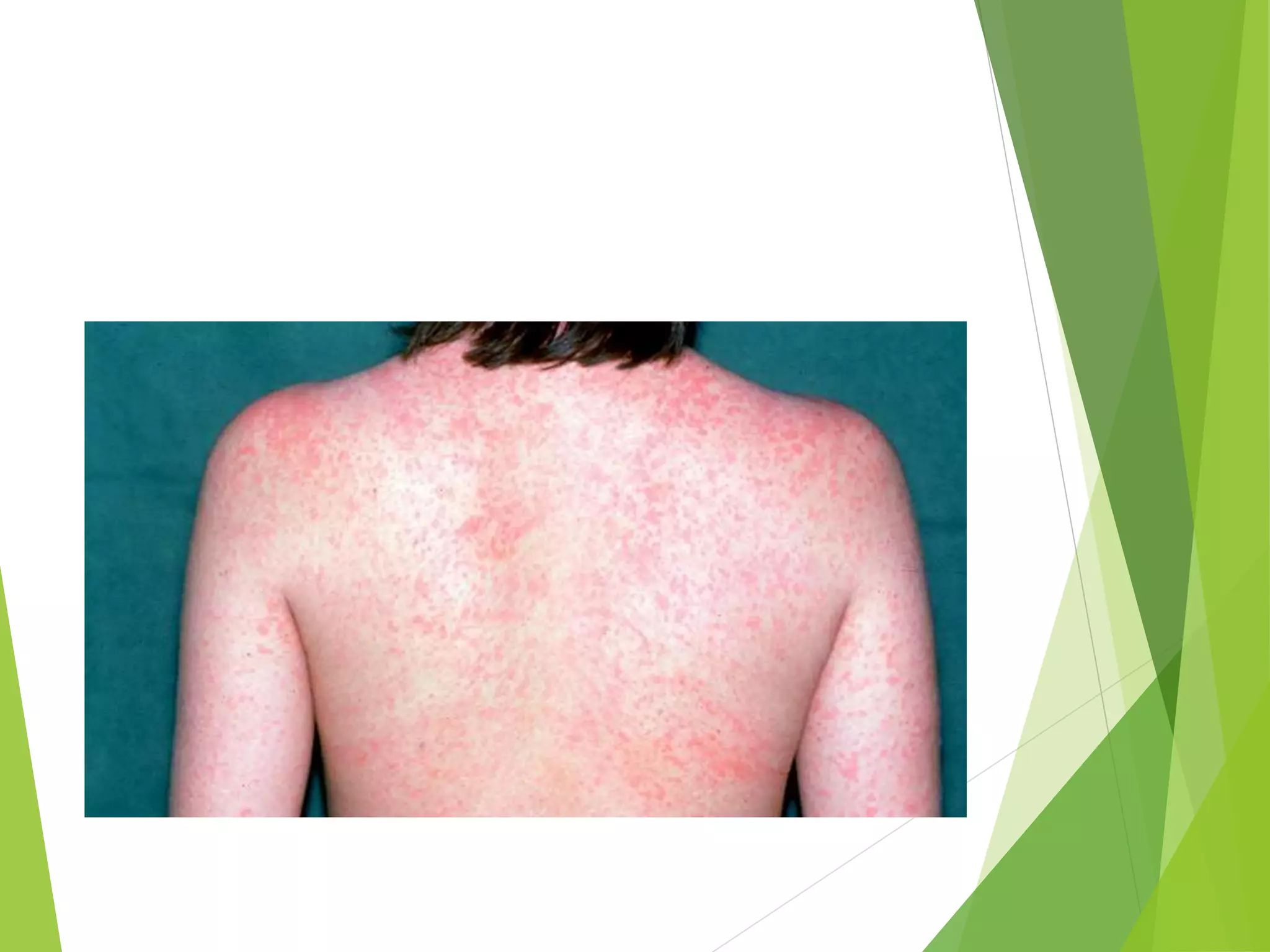 approach to child with fever and Rash | PPTX